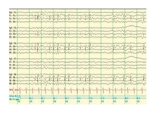 approach to first seizure.pptx