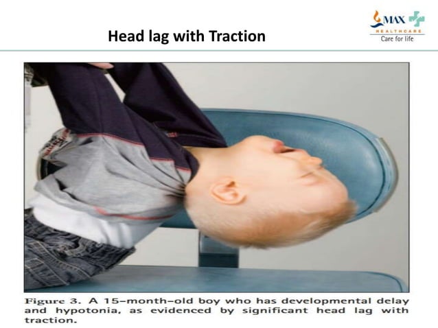 Approach to floppy infant | PPTX | Brain and Nervous System Disorders ...