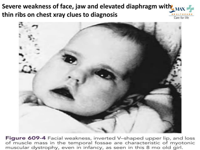 Approach to floppy infant | PPTX | Brain and Nervous System Disorders ...