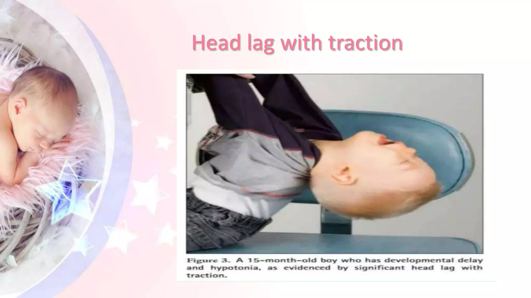 Approach to floppy infant | PPTX