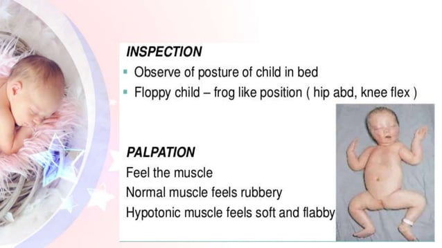 Approach to floppy infant | PPTX | Brain and Nervous System Disorders ...