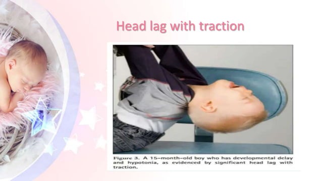 Approach to floppy infant | PPTX | Brain and Nervous System Disorders ...