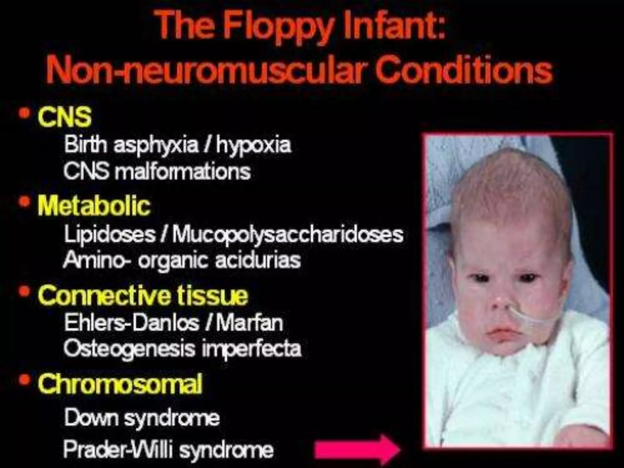 Approach to Floppy Infant.ppt