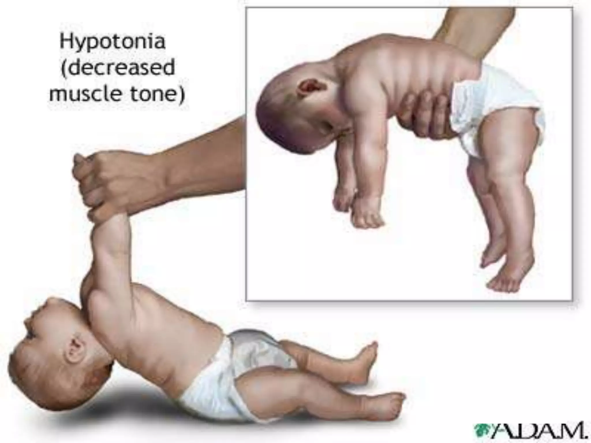 Approach to Floppy Infant.ppt