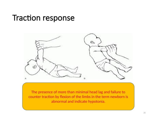 Approach_to_floppy_infant_presentation_slides | PPT