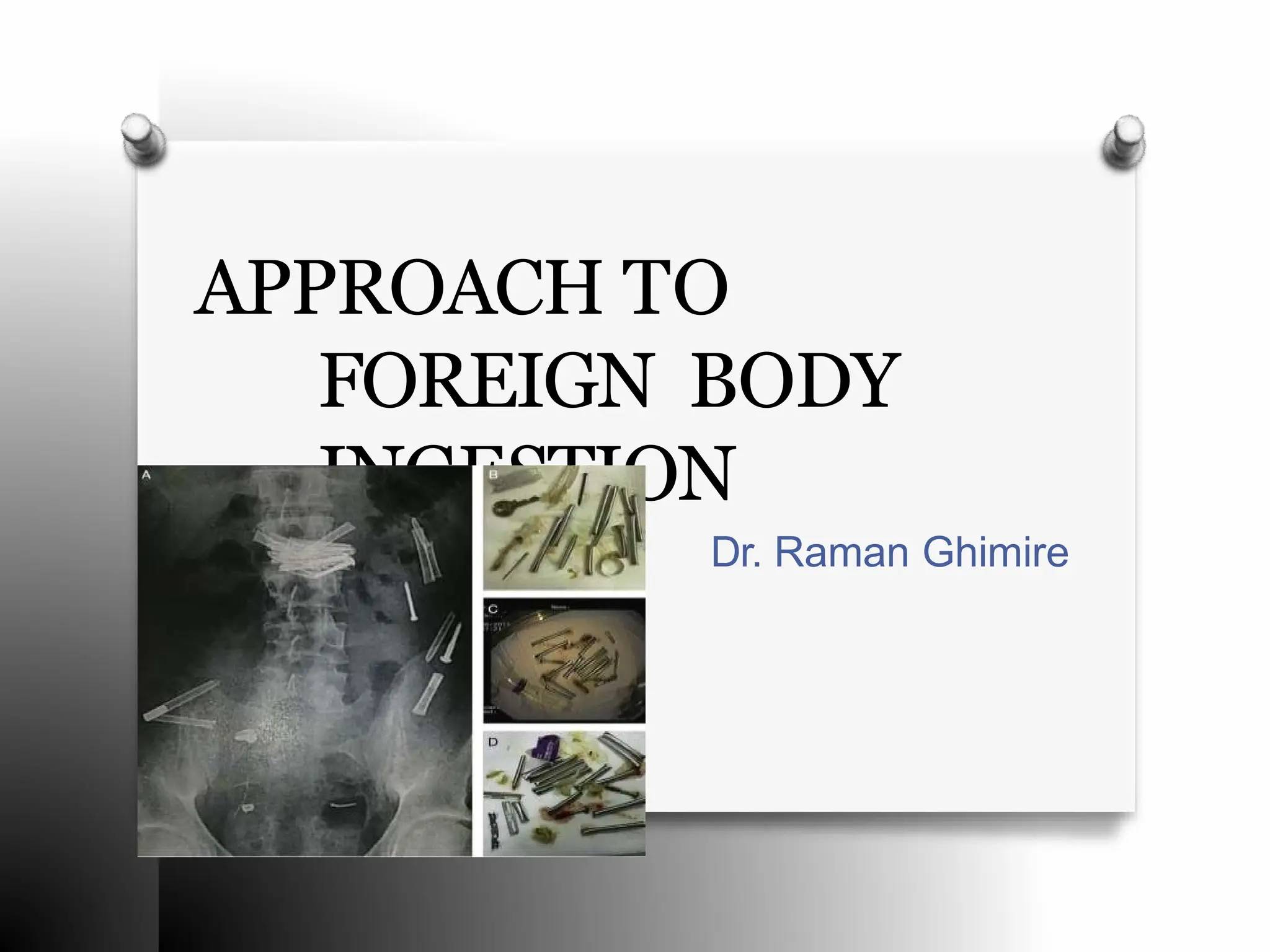 approach to the foreign body ingestion.pptx
