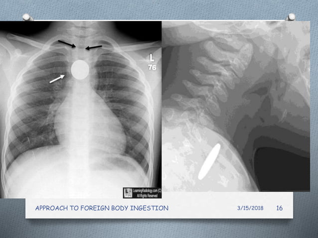 Approach to foreign body ingestion | PPTX