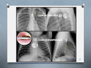 Approach to foreign body ingestion | PPTX