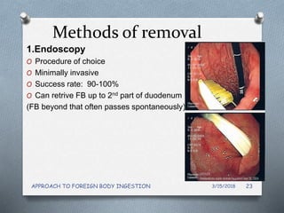 Approach to foreign body ingestion | PPTX