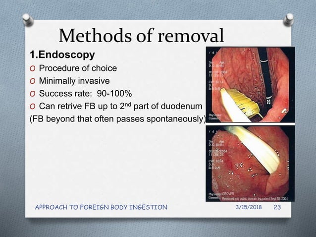 Approach to foreign body ingestion | PPTX