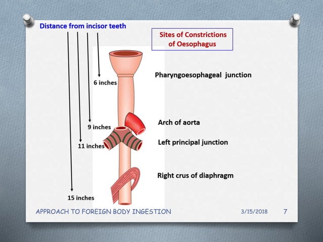 Approach to foreign body ingestion | PPTX