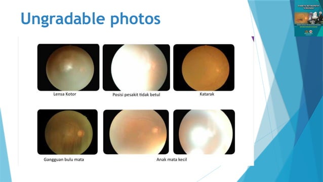 Approach to fundus camera- Reading and interpretation 2.pptx