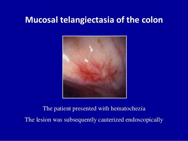 Approach to gastrointestinal bleeding