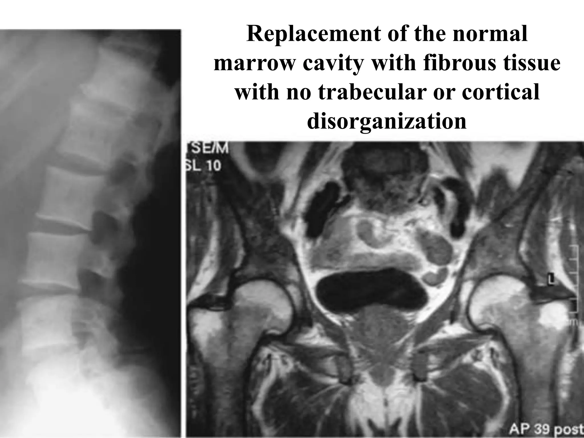 Approach to generalised increased bone density | PPTX