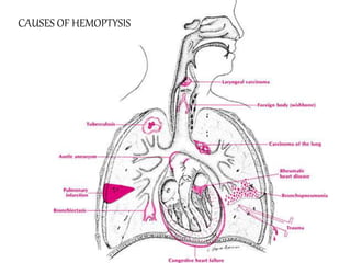Approach to haemoptysis (2) copy.pptx