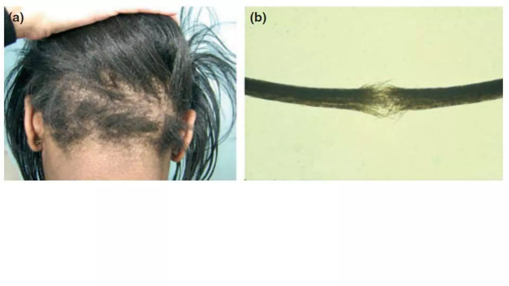 Approach to hair shaft disorders | PPTX