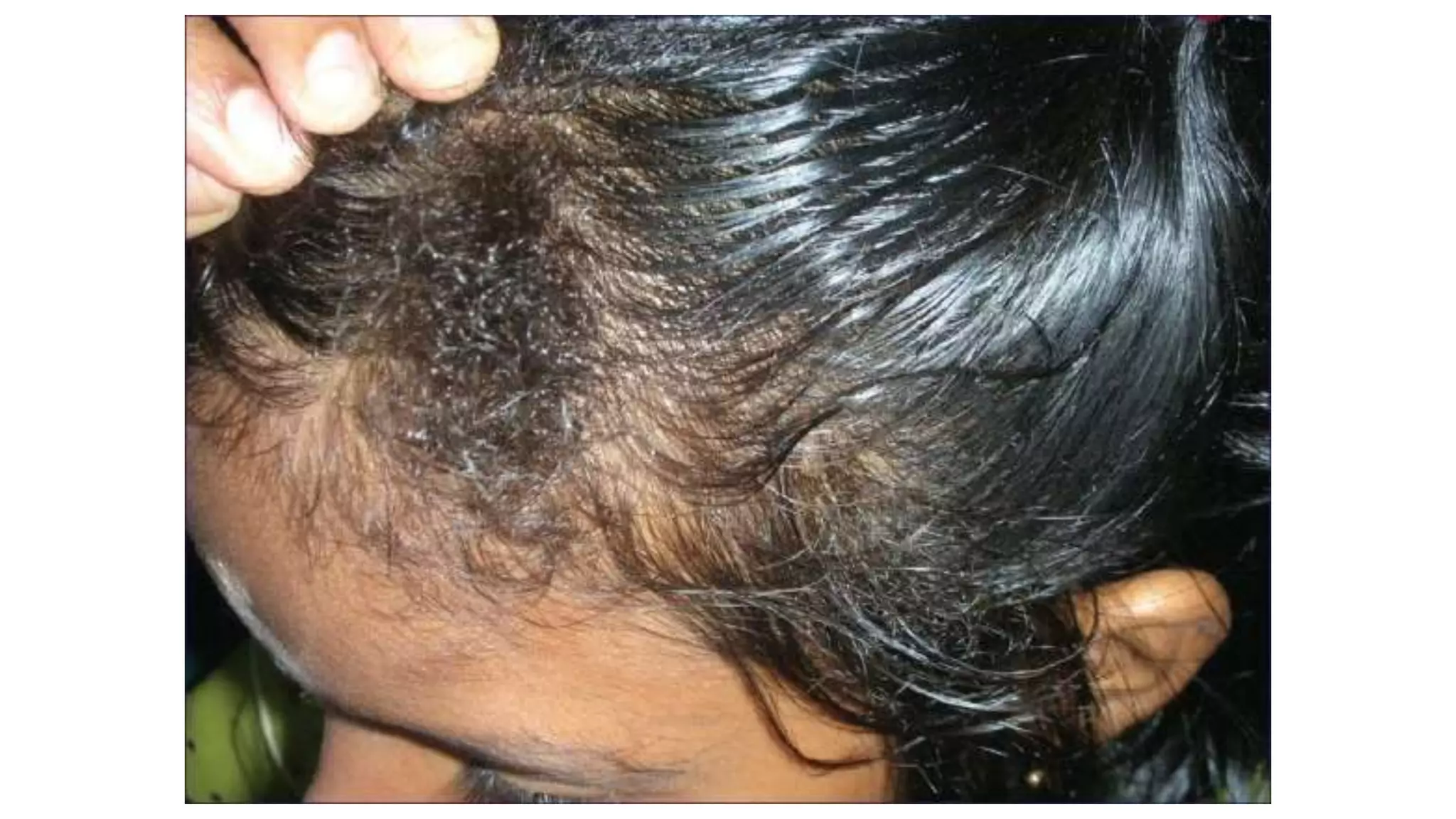 Approach to hair shaft disorders | PPTX