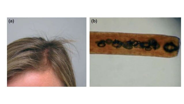 Approach to hair shaft disorders | PPTX | Hair Care | Beauty