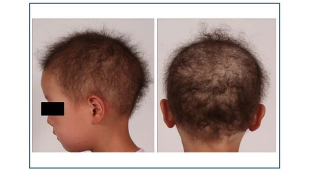 Approach to hair shaft disorders | PPTX | Hair Care | Beauty