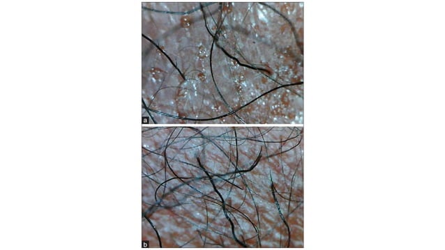 Approach to hair shaft disorders | PPTX | Hair Care | Beauty
