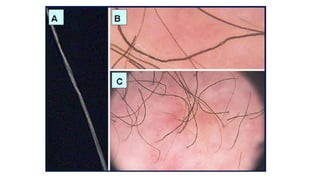 Approach to hair shaft disorders | PPTX