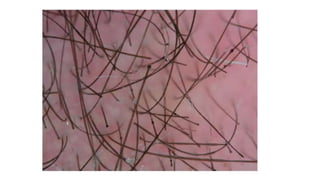 Approach to hair shaft disorders | PPTX