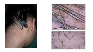 Approach to hair shaft disorders | PPTX