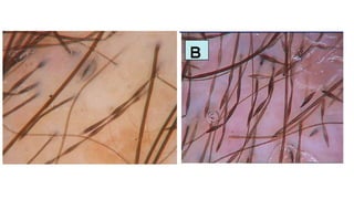 Approach to hair shaft disorders | PPTX