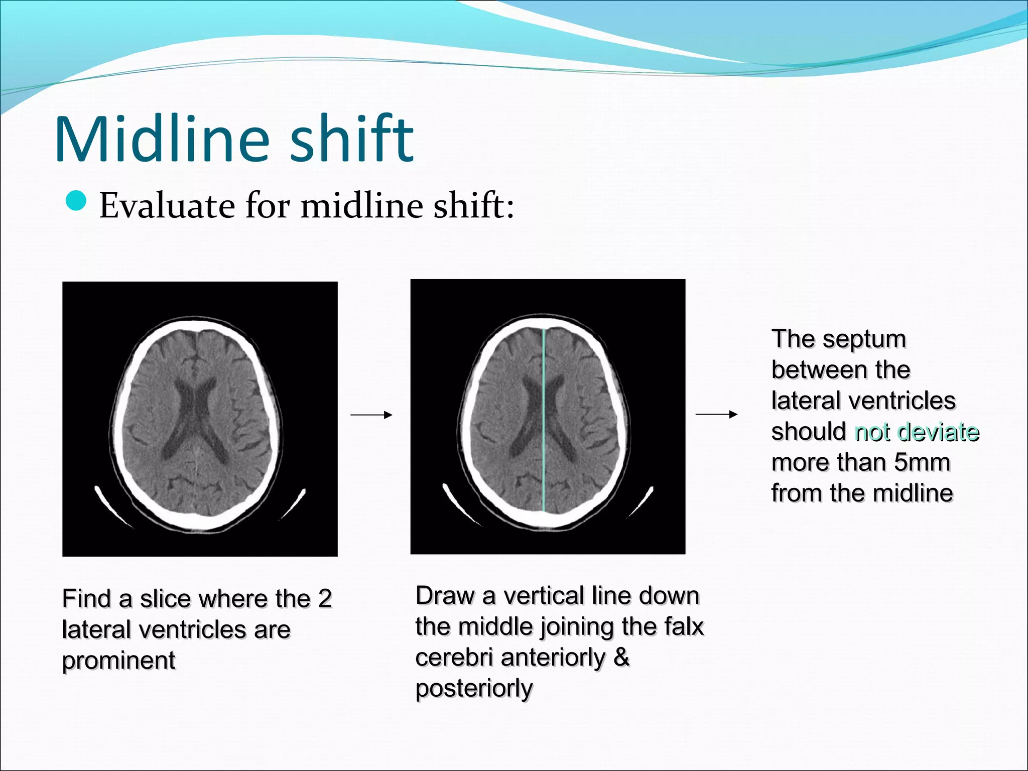 Approach to head ct | PPT