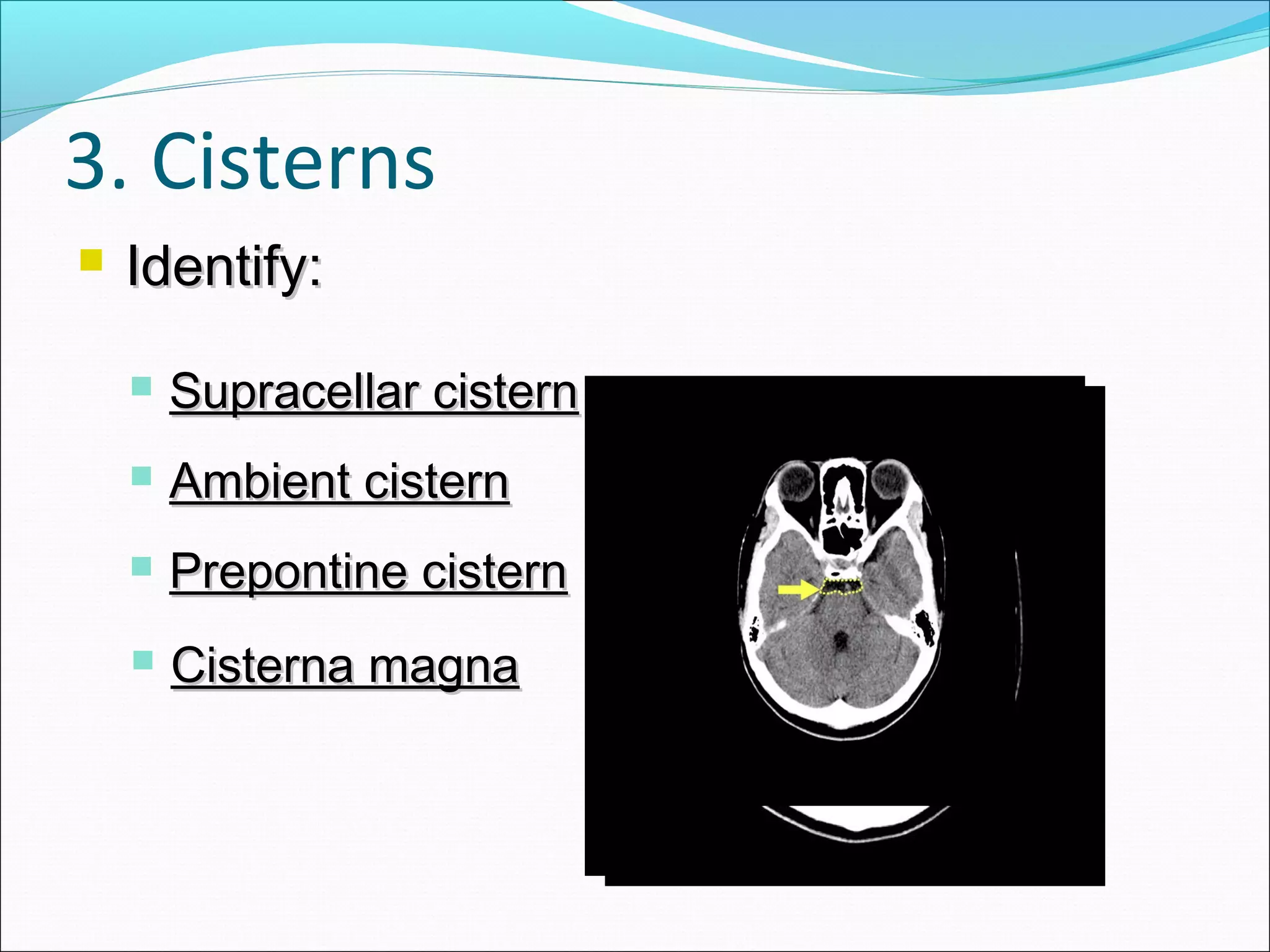 Approach to head ct | PPT