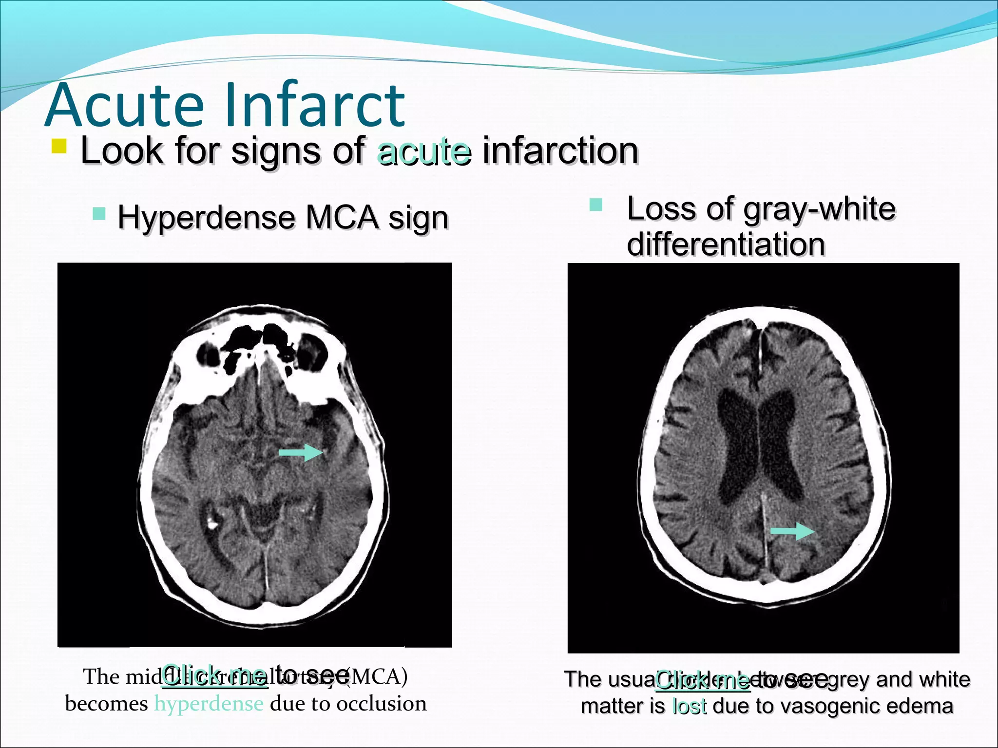 Approach to head ct | PPT