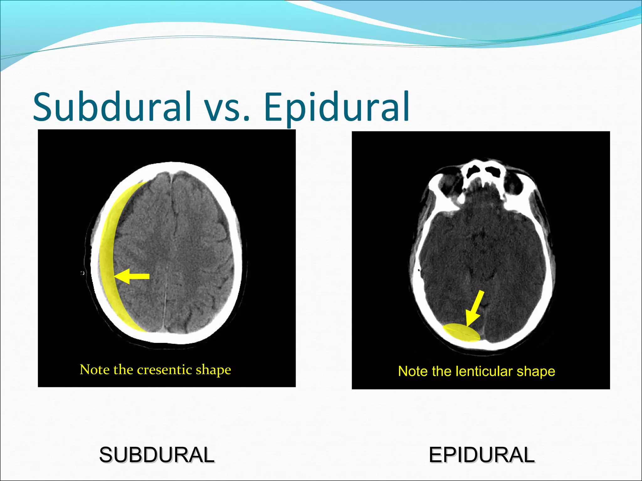 Approach to head ct | PPT