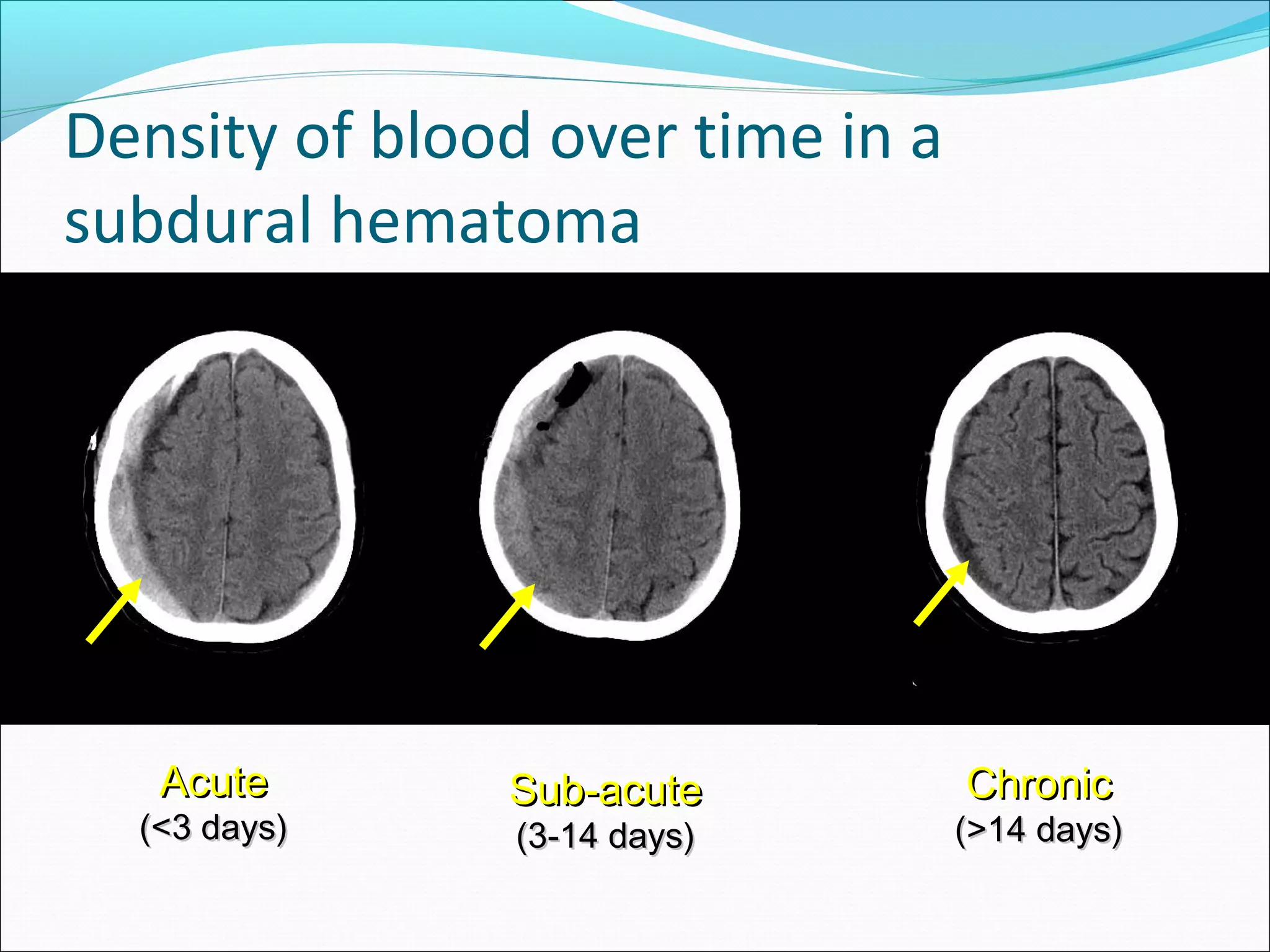 Approach to head ct | PPT