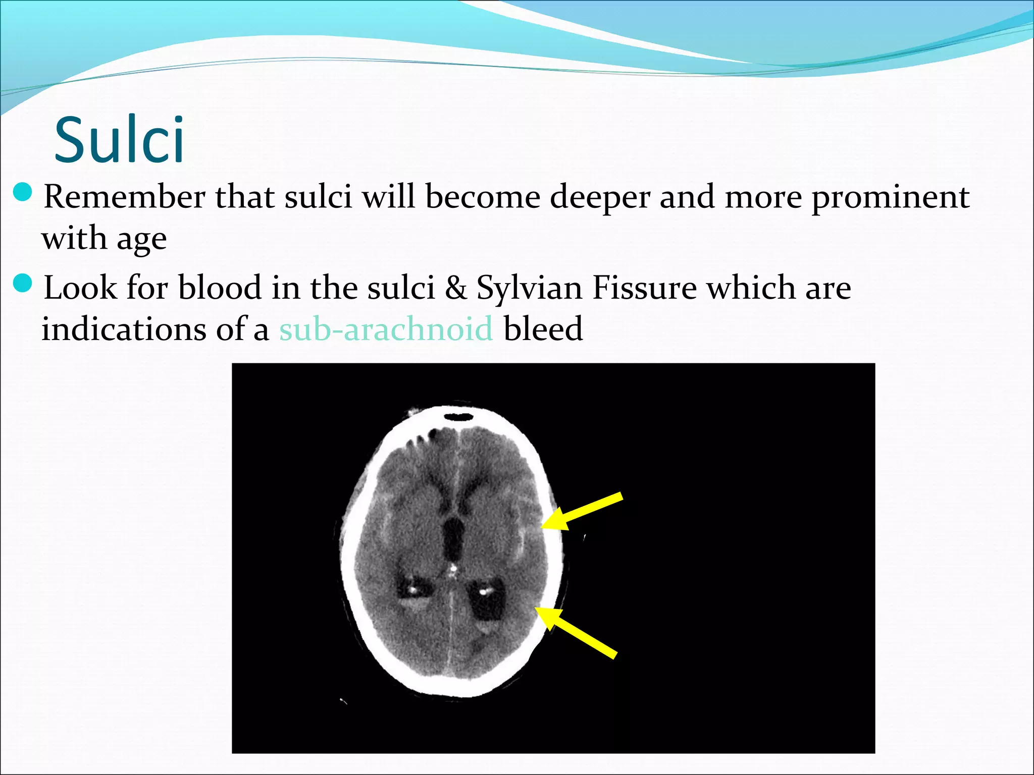 Approach to head ct | PPT