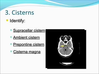 Approach to head ct | PPT