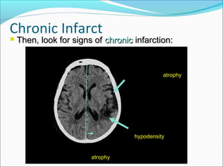 Approach to head ct | PPT