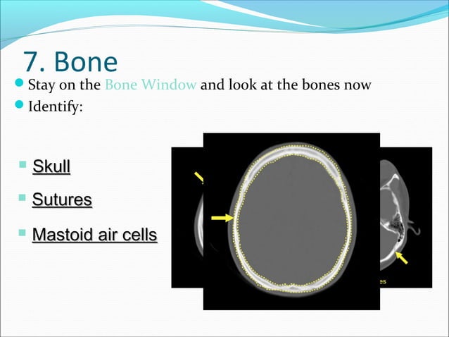 Approach to head ct | PPT