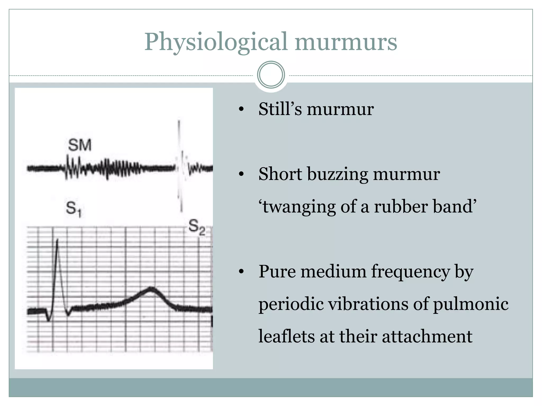 Approach to Heart Murmurs.pptx