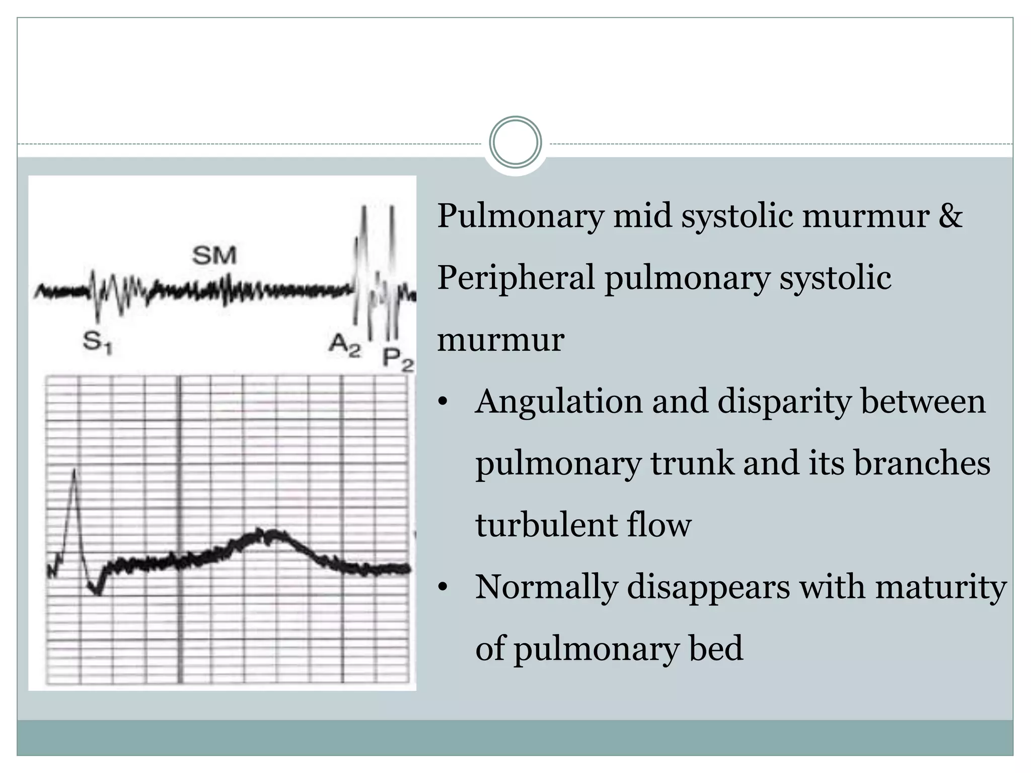 Approach to Heart Murmurs.pptx