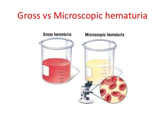 Approach to hematuria