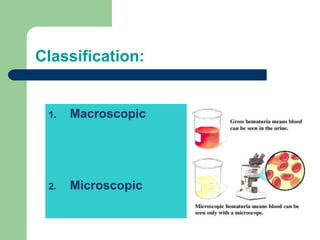Approach to hematuria - general | PPT