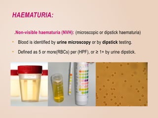 Approach to hematuriaAAAAAAAAAAAAAAA (2).pptx