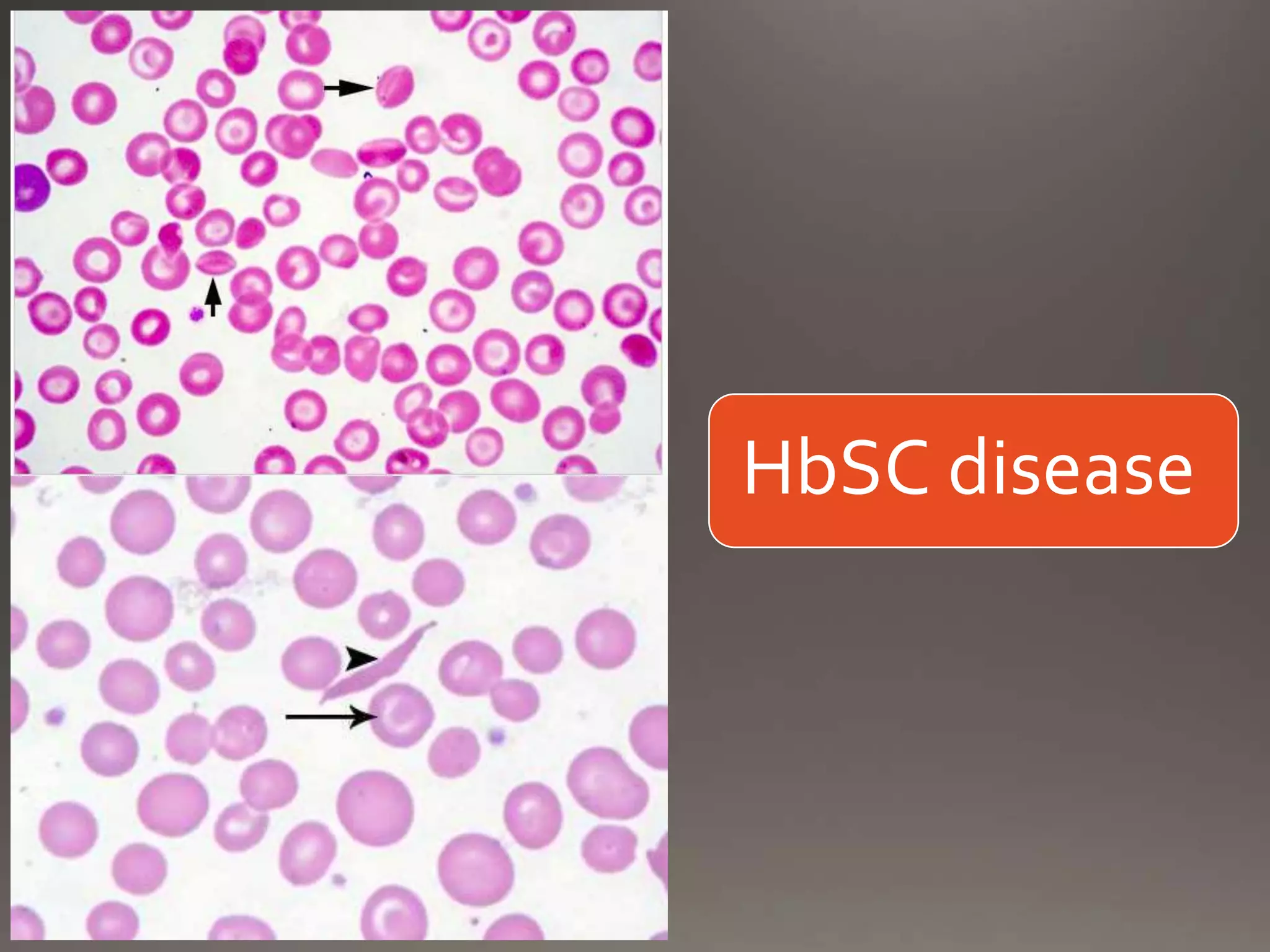 Hemoglobinopathies - Lab diagnosis | PPTX