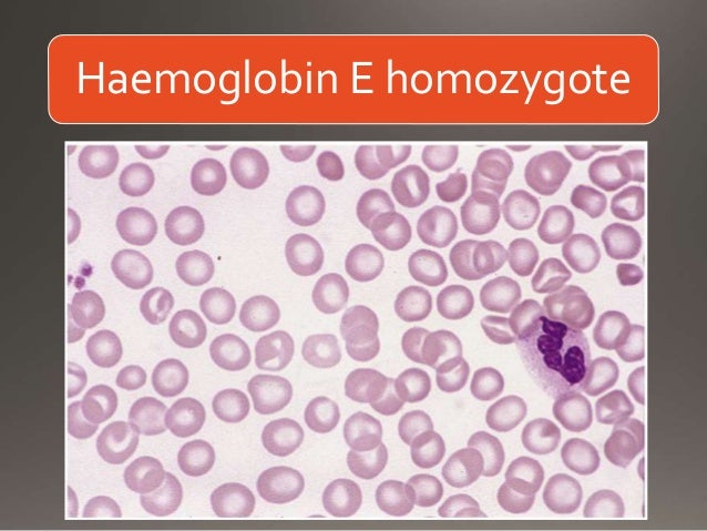 Hemoglobinopathies - Lab diagnosis