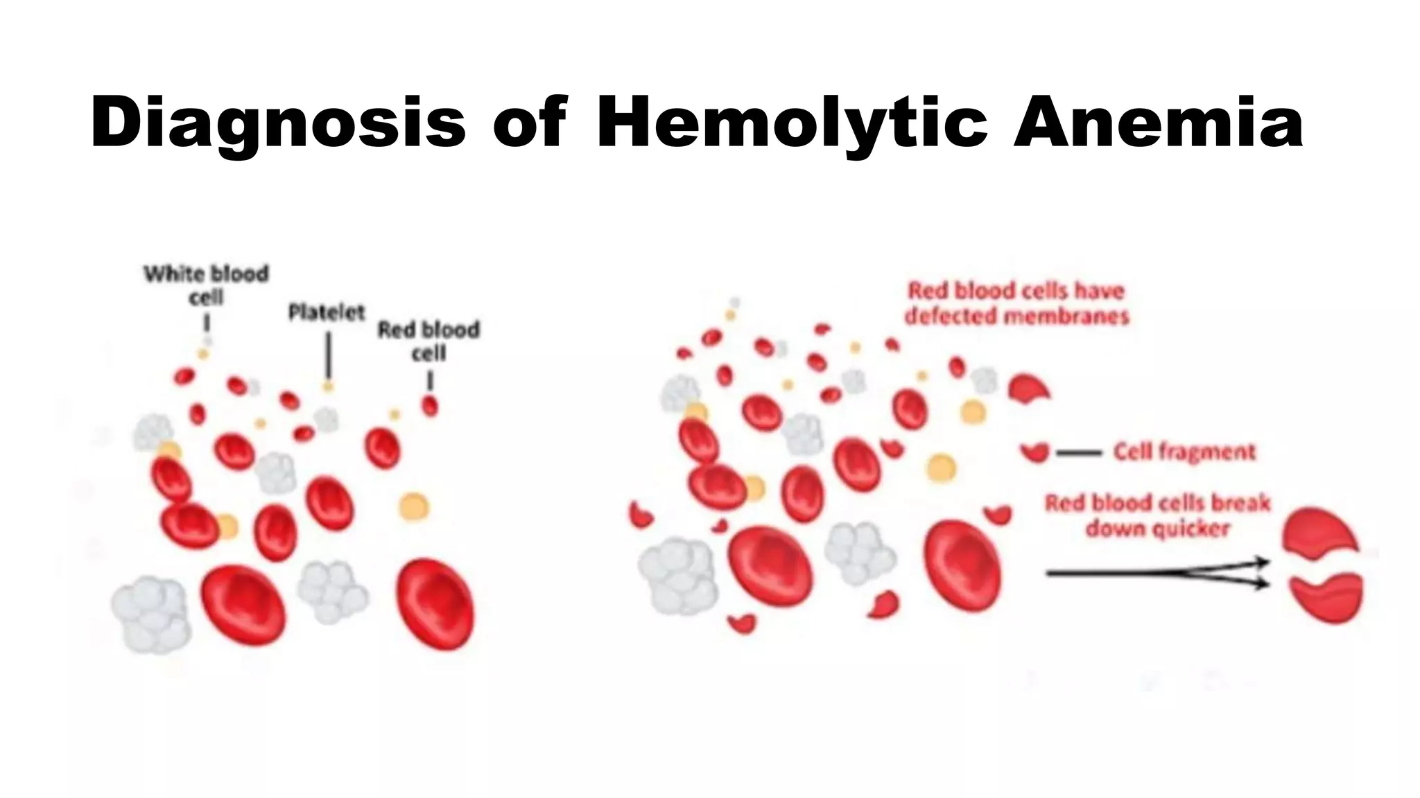 Diagnosis of hemolytic anemia | PPTX