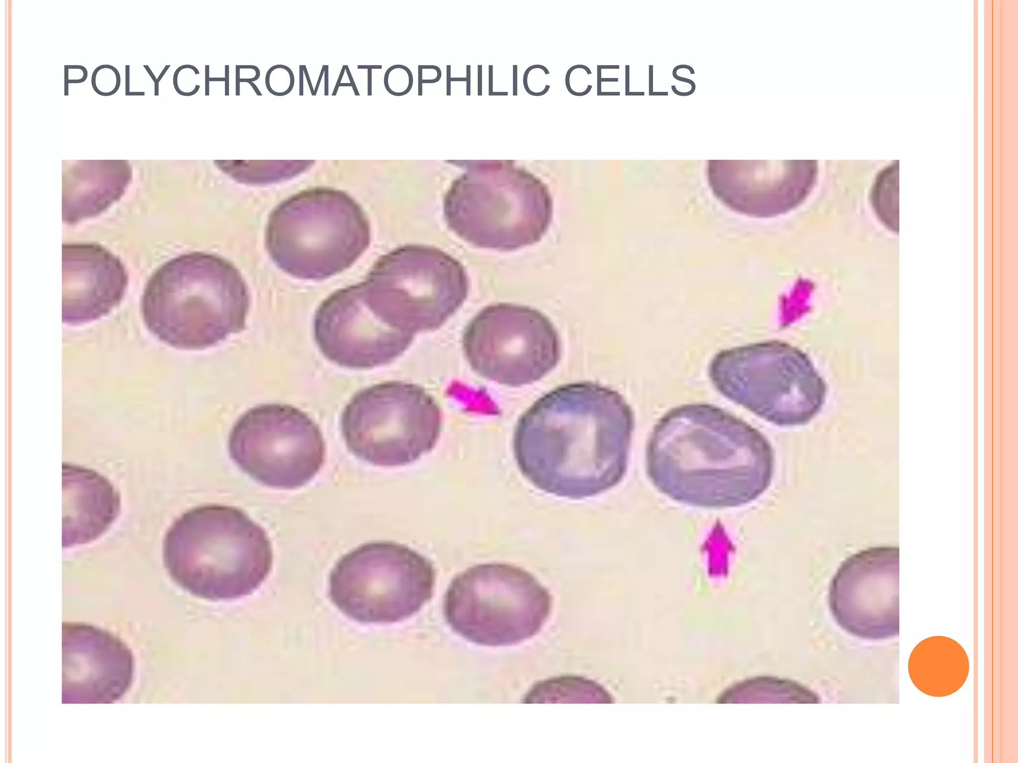Approach to hemolytic anemia naglaa | PPT