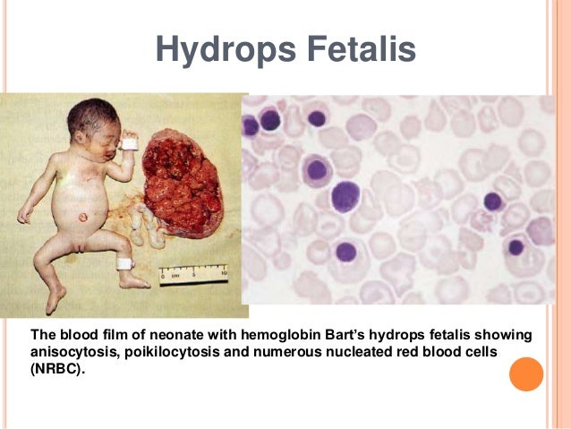 Approach to hemolytic anemia naglaa