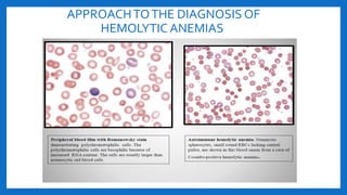 Approach to hemolytic anemias | PPTX