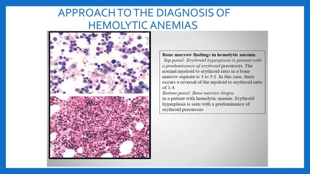 Approach to hemolytic anemias | PPTX | Blood Disorders | Diseases and ...