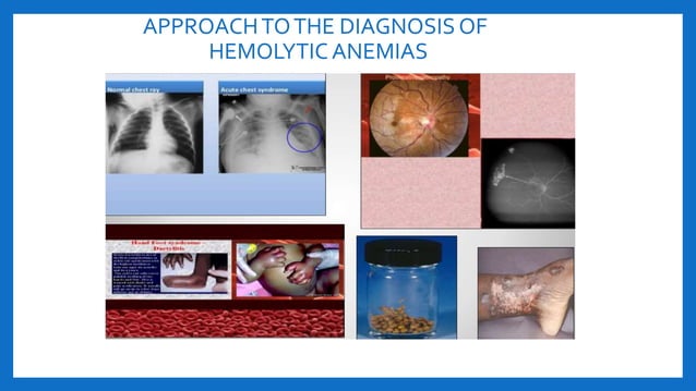 Approach to hemolytic anemias | PPTX | Blood Disorders | Diseases and ...